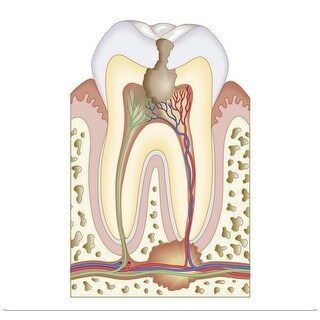 Cross section biomedical illustration of pulp and root abscess in molar ...