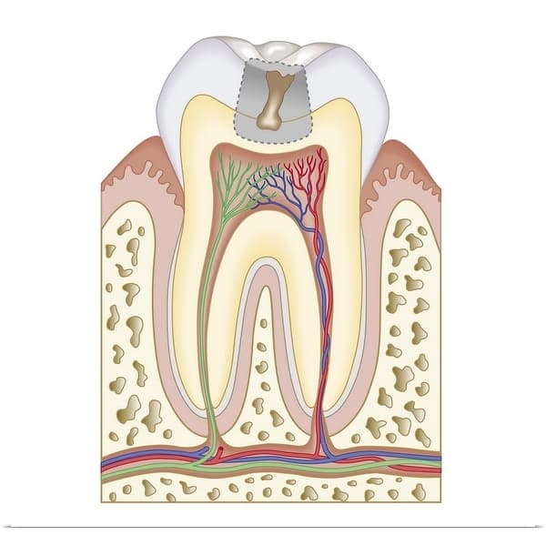 Cross section biomedical illustration of tooth decay before dental ...