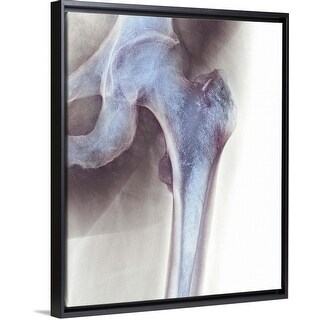 "Normal hip, X-ray" Black Float Frame Canvas Art - Bed Bath & Beyond ...